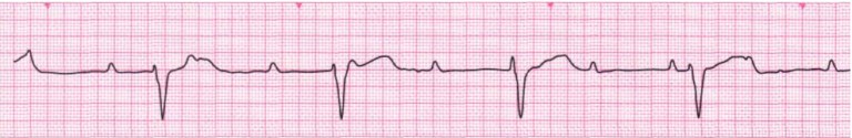 12 Lead ECG – EmergencyPedia
