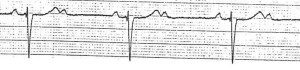 12 Lead ECG – EmergencyPedia