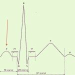 12 Lead ECG – EmergencyPedia