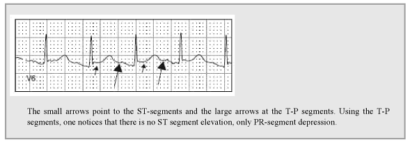 12 Lead ECG – EmergencyPedia