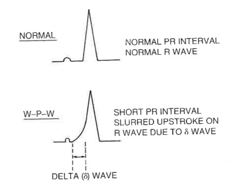 12 Lead ECG – EmergencyPedia