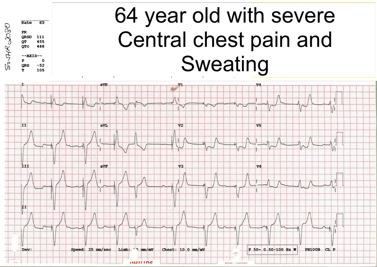Sgarbossa Criteria in Bundle Branch Blocks and Paced Rhythm ...