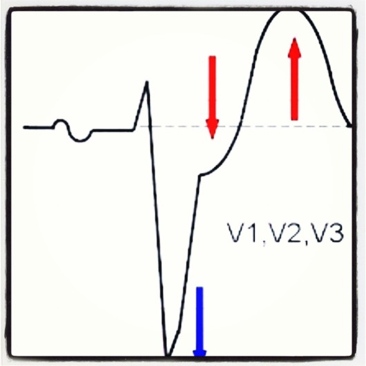 Sgarbossa Criteria in Bundle Branch Blocks and Paced Rhythm ...