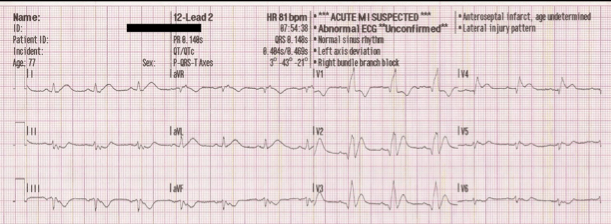 Sgarbossa Criteria in Bundle Branch Blocks and Paced Rhythm ...