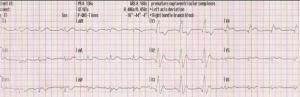 Sgarbossa Criteria in Bundle Branch Blocks and Paced Rhythm ...