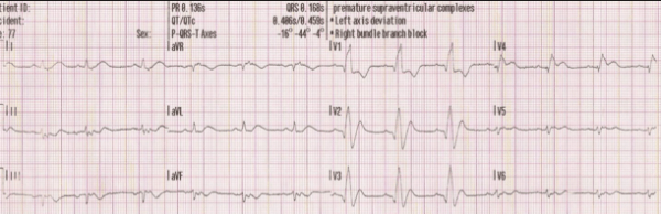 Sgarbossa Criteria in Bundle Branch Blocks and Paced Rhythm ...