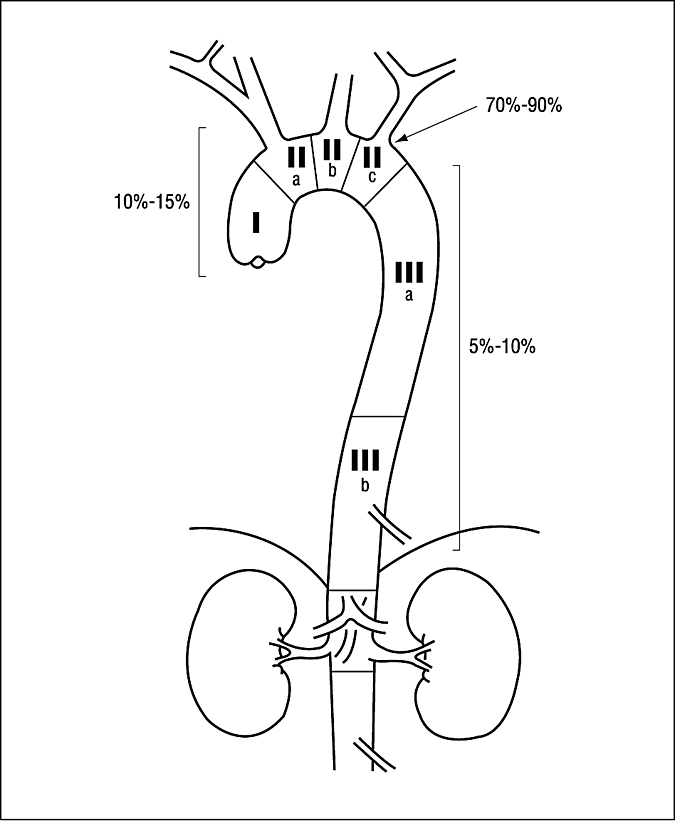 Aortic Injuries and Aortic Dissection – EmergencyPedia