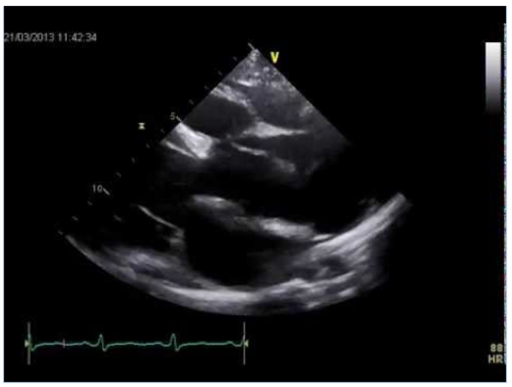 Aortic Injuries and Aortic Dissection – EmergencyPedia