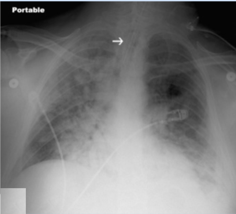 Acute Respiratory Distress Syndrome (ARDS) – EmergencyPedia