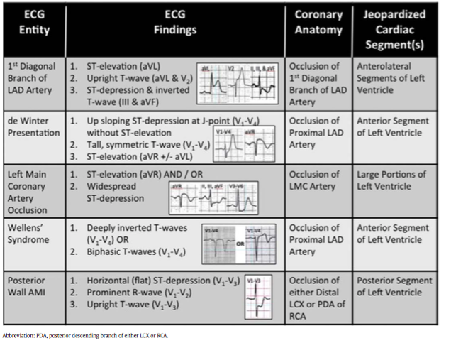 ECG – The “MI Equivalents” – EmergencyPedia