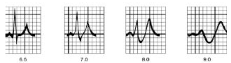 Acute Hyperkalaemia Review – EmergencyPedia